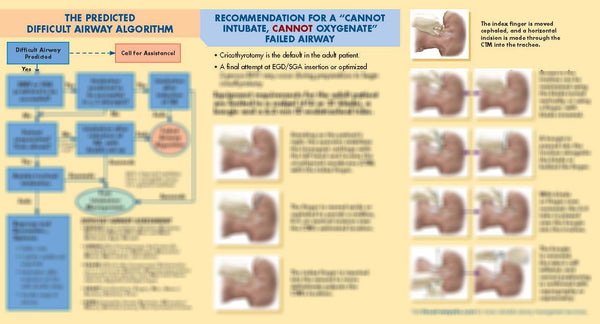The Airway Card: Anesthesia (v2.0) – The Airway Store